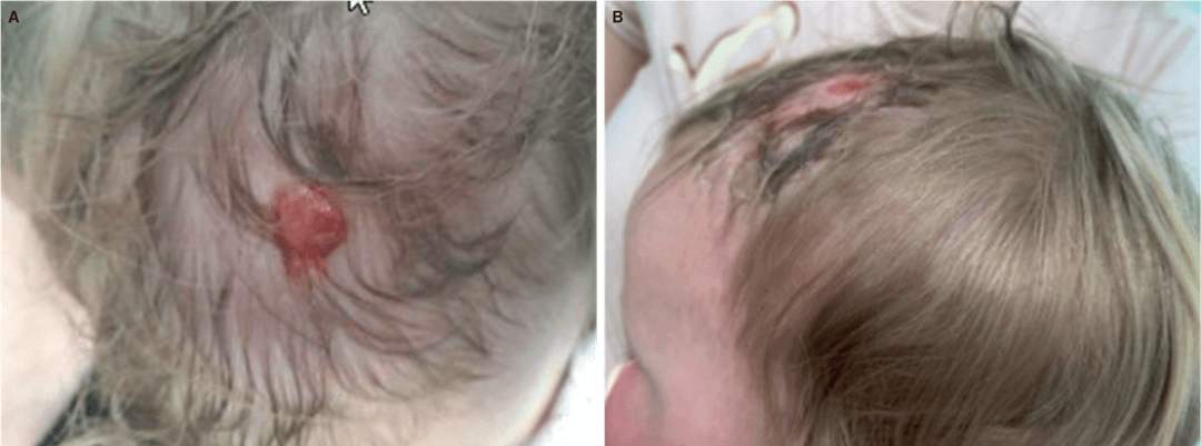 Pyogent granulom behandlet med almindeligt bordsalt | Ugeskriftet.dk