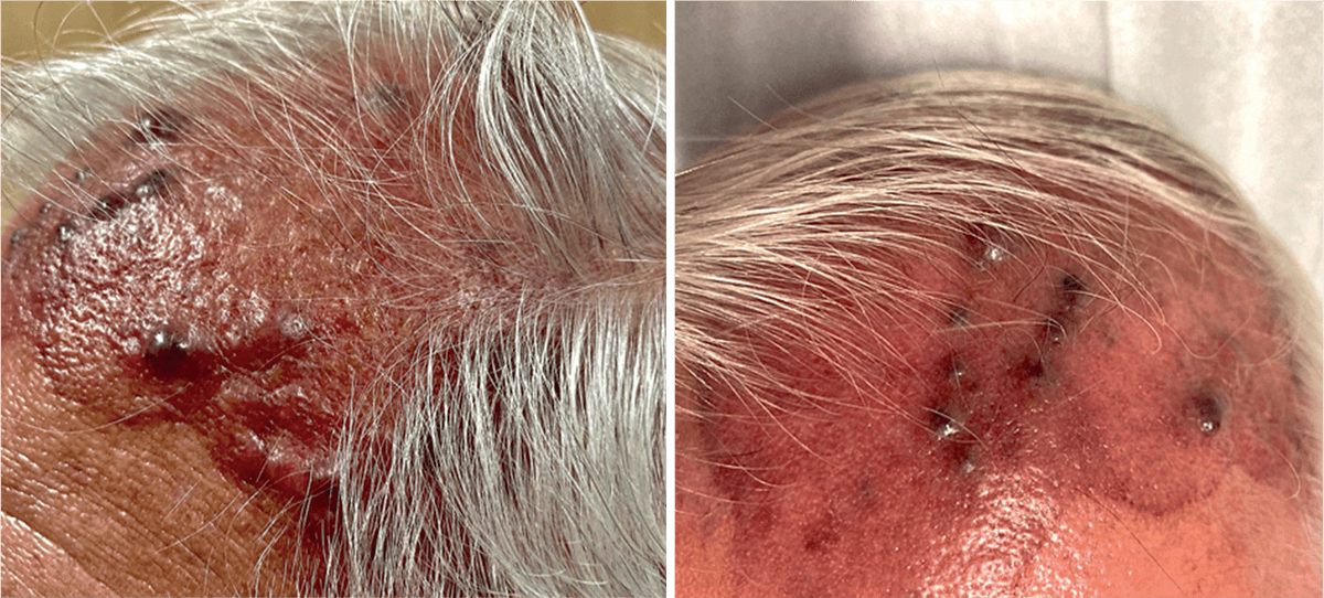 Angiosarkom | Ugeskriftet.dk