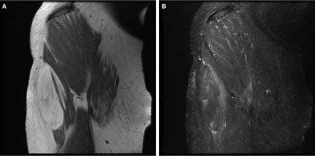 Klinisk retningslinje for udredning og behandling af lipomer ...