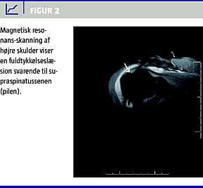 Luxatio erecta - en sjælden form for skulderluksation | Ugeskriftet.dk