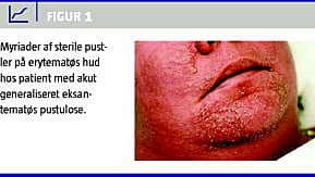 Akut generaliseret eksantematøs pustulose | Ugeskriftet.dk