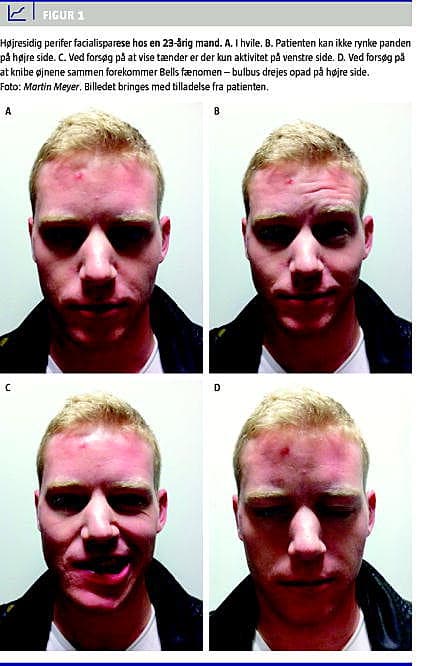 Behandling af idiopatisk perifer facialisparese, også kaldet Bells ...