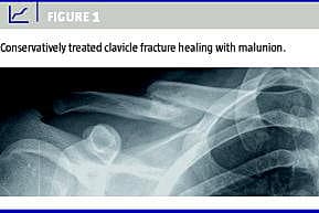 Acceptable resultater efter konservativ behandling af klavikelfraktur ...