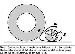 Decollement | Ugeskriftet.dk