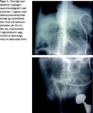 Toksisk megacolon sekundært til Clostridium difficile-associeret ...