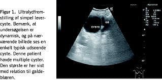 Levercyster | Ugeskriftet.dk
