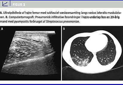 Pyomyositis forårsaget af Streptococcus pneumoniae hos tidligere rask ...