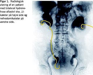 Aflastning af tumorbetinget obstruerede øvre urinveje ved ...