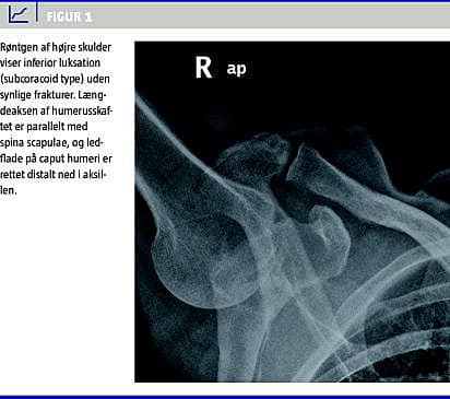 Luxatio erecta - en sjælden form for skulderluksation | Ugeskriftet.dk