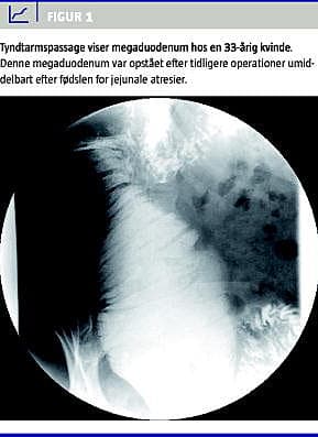 Megaduodenum og obstipation efter operation for kongenit ...