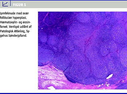 Lymfomsuspekt cervikal lymfadenitis som primær manifestation af ...