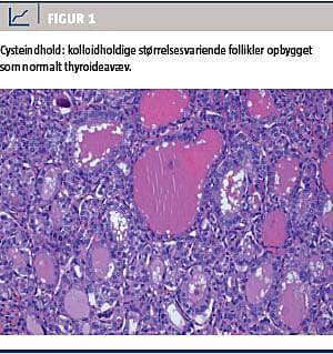 Hypotyroidisme efter operation for struma ovarii | Ugeskriftet.dk