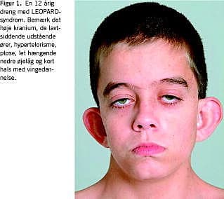 LEOPARD-syndrom | Ugeskriftet.dk