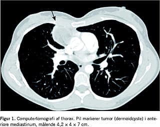 Dermoidcyste med atypiske symptomer fra overekstremiteterne ...