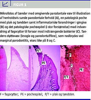 Marginal parodontitis er en af de almindeligste inflammatoriske ...