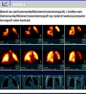 SPECT kombineret med CT-angiografi giver bedre diagnostik af ...