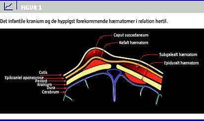Fatalt forløb ved neonatalt subgalealt hæmatom efter vakuumekstraktion ...