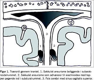 Subduralt hæmatom fra aneurisme uden samtidig subaraknoidalblødning ...