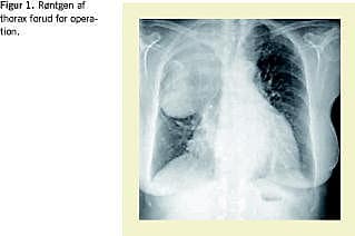 Intratorakal struma med differentialdiagnostiske vanskeligheder ...