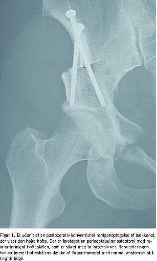 Periacetabulær osteotomi og hoftedysplasi hos yngre voksne | Ugeskriftet.dk