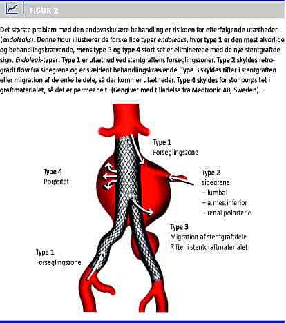 Fortsat behov for både endovaskulær og åben kirurgisk behandling af abdominalt aortaaneurisme ...