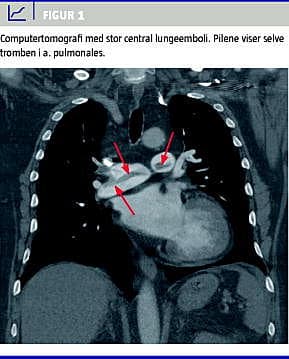 Hjertestop forårsaget af lungeemboli behandlet med trombolyse ...