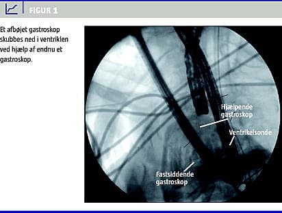 Uventet komplikation ved gastroskopi hos patient med stort hiatushernie ...