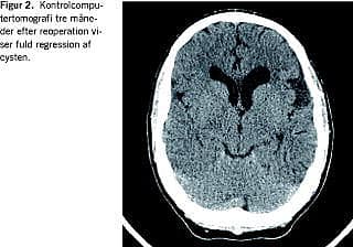 Livstruende subduralt hæmatom hos yngre mand | Ugeskriftet.dk