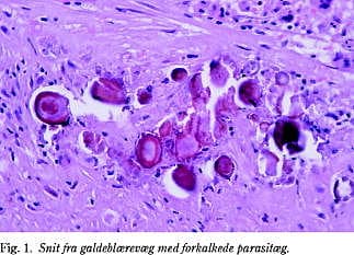 Parasitær galdevejsinfektion | Ugeskriftet.dk