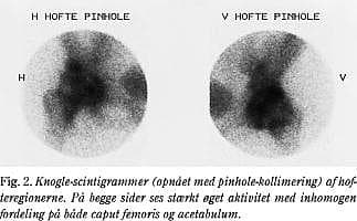 Bilateral nekrose af caput femoris efter brug af arbejdssele ...