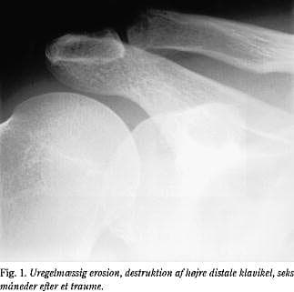 Posttraumatisk osteolyse af distale klavikel | Ugeskriftet.dk