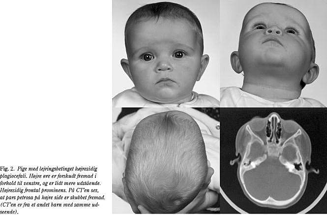 Lejringsbetinget plagiocefali | Ugeskriftet.dk