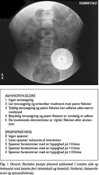 Intratekal baclofenbehandling ved svær spastisk tetraplegi og dystoni ...