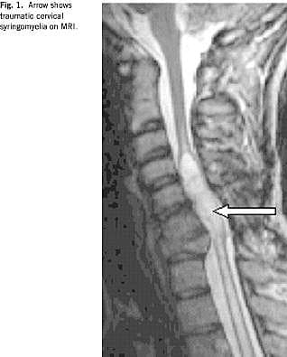 Posttraumatisk syringomyeli | Ugeskriftet.dk