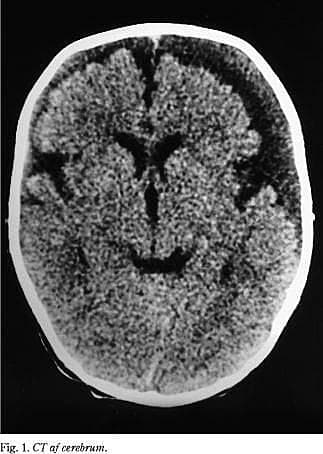 »Shaken baby syndrome« - ruskevold mod spædbørn | Ugeskriftet.dk