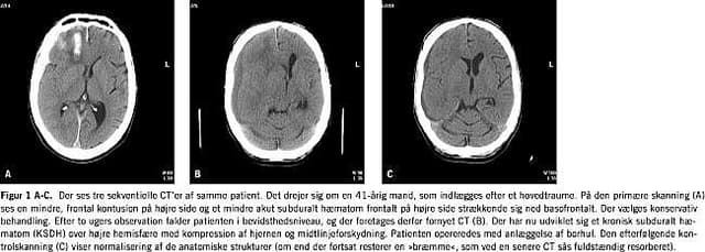 Kronisk subduralt hæmatom | Ugeskriftet.dk