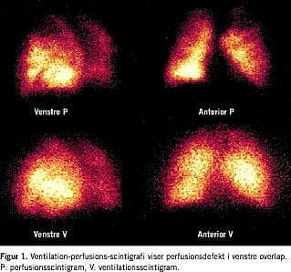 Emfysem: en højopløsning-CT-diagnose | Ugeskriftet.dk