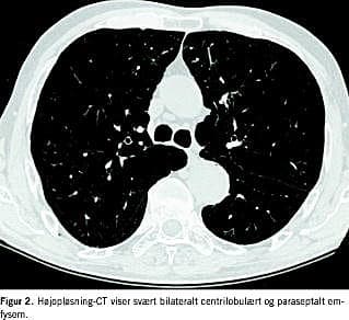 Emfysem: en højopløsning-CT-diagnose | Ugeskriftet.dk