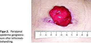 Infliximabbehandling af peristomal pyoderma gangraenosum ved colitis ...