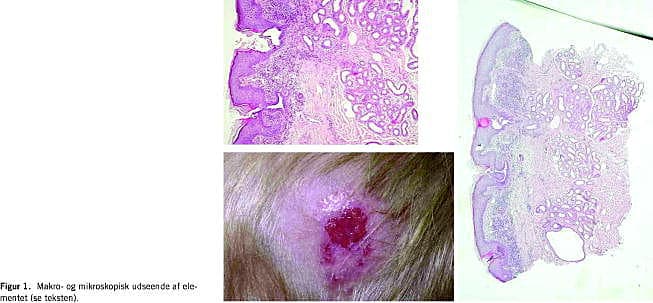 Organoidt nævus (naevus sebaceus) med apokrin dominans | Ugeskriftet.dk