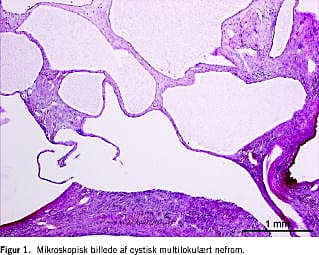 To tilfælde af multilokulær cystisk nefrom, en sjælden benign nyretumor ...