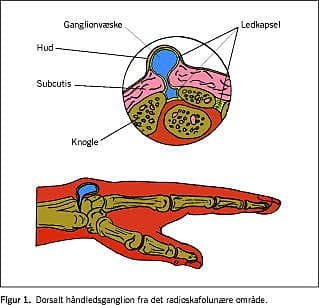 Ganglion - seneknude på hånd og håndled | Ugeskriftet.dk