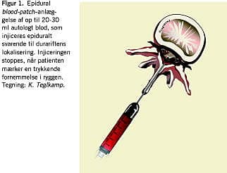 Postdural hovedpine gennem fire år | Ugeskriftet.dk