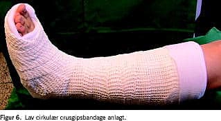 Anlæggelse af gipsskinne/bandagering af underben og ankel | Ugeskriftet.dk