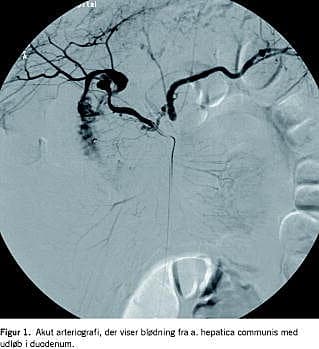 Coiling af a. hepatica communis ved livstruende blødning hos en patient ...