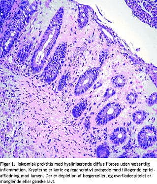 Akut iskæmisk proktitis efter et epileptisk anfald | Ugeskriftet.dk