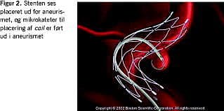 Diagnostik og behandling ved subaraknoidalblødning | Ugeskriftet.dk