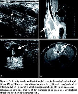 Bicipitoradial bursitis | Ugeskriftet.dk