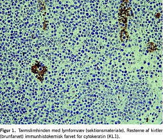 Epstein-Barr-virus-associeret lymfom hos en patient med colitis ...
