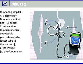 Duodopapumpebehandling til patienter med fremskreden Parkinsons sygdom ...